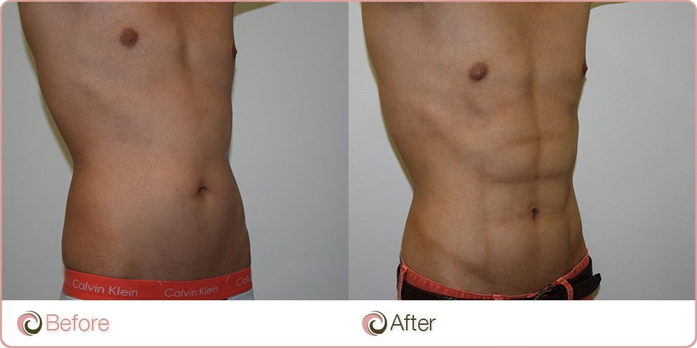 How Much Fat Can Liposuction Safely Remove?