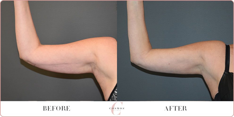 Arm Liposuction Before & After